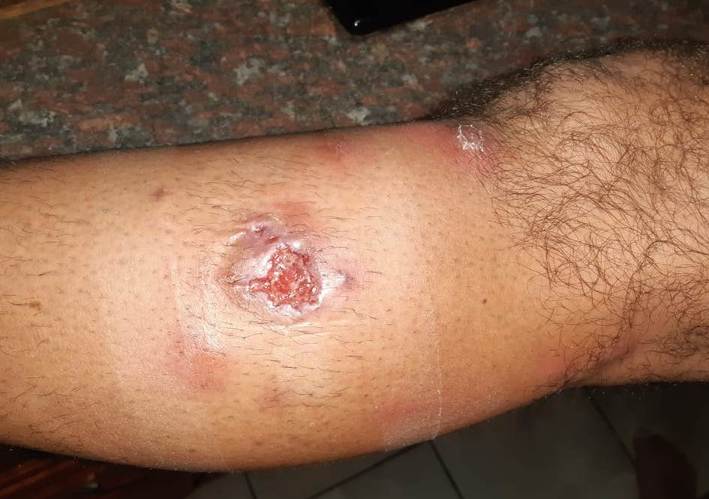 Mnr. Dirk Smith se wond nadat ’n spinnekop hom gebyt het. – Ridge Times